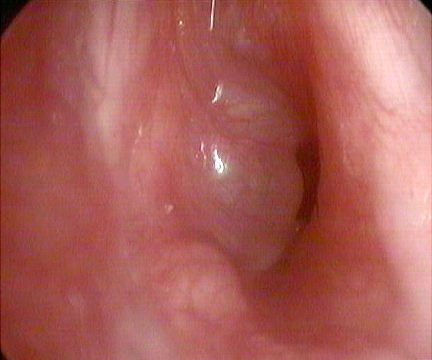 subglottic cyst