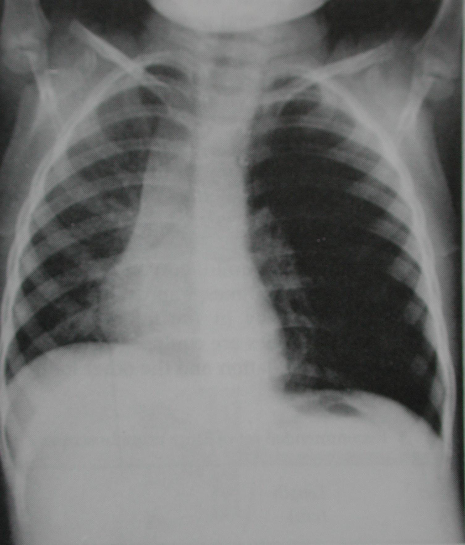 obstructive emphysema foreign body